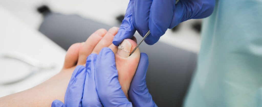 How Does a Chiropodist Treat an Ingrown Toenail - Dundas University ...